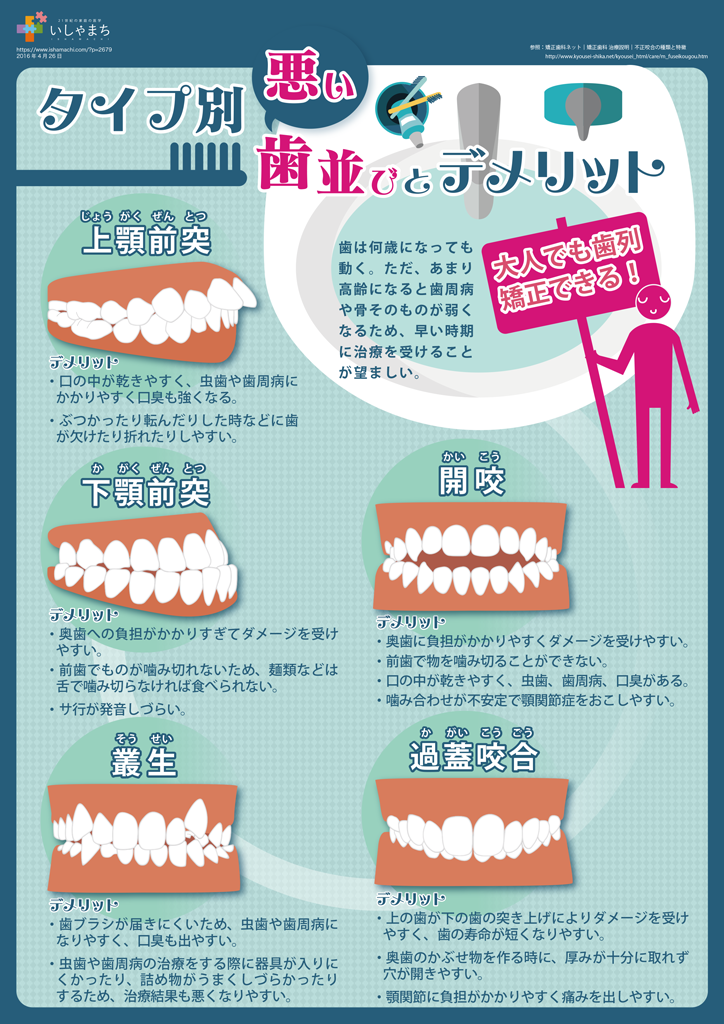 Poor-alignment-of-teeth – いしゃまち